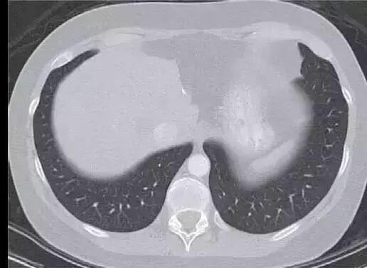 朗格汉斯组织细胞增生症