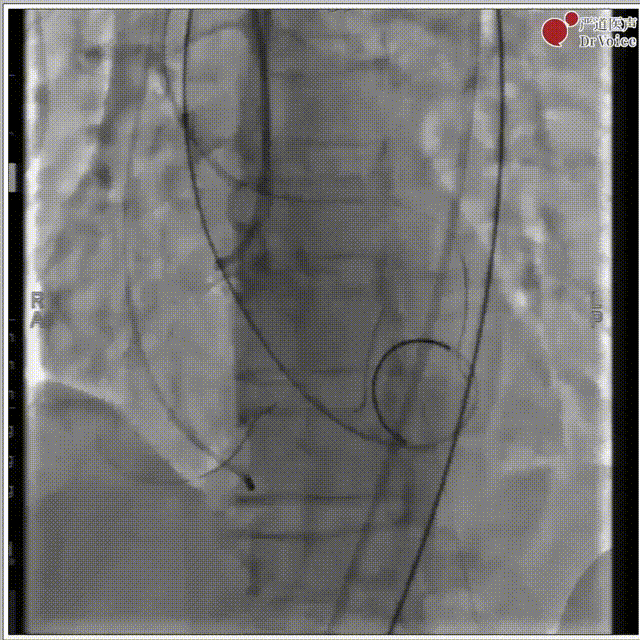 云南大学附属医院张新金教授团队完成云南省首例美敦力Evolut PRO植入 -- 严道医声网