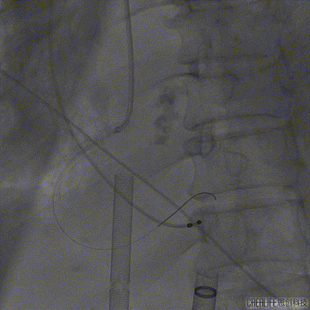 九江市第一人民医院生命活水心血管病医院完成ECMO支持下PCI+TAVR克艰难险阻 创生命奇迹 -- 严道医声网