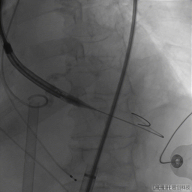 九江市第一人民医院生命活水心血管病医院完成ECMO支持下PCI+TAVR克艰难险阻 创生命奇迹 -- 严道医声网
