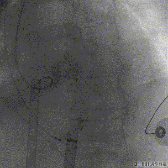 九江市第一人民医院生命活水心血管病医院完成ECMO支持下PCI+TAVR克艰难险阻 创生命奇迹 -- 严道医声网