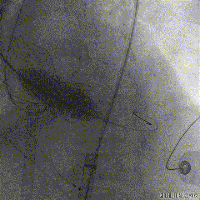 九江市第一人民医院生命活水心血管病医院完成ECMO支持下PCI+TAVR克艰难险阻 创生命奇迹 -- 严道医声网