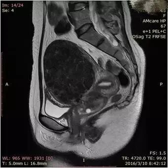 哪些子宫肌瘤、子宫腺肌症肌患者适合做磁波消融术治疗？-子宫肌瘤- 上海红睦房中城医院
