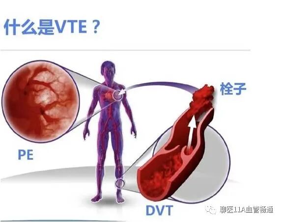 静脉血栓早知道，做好预防最重要！-南通科威瀚医疗科技有限公司网站