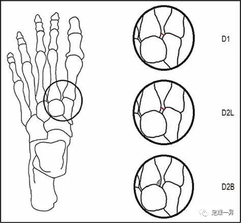 3分钟Get：Lisfranc损伤的诊疗策略！-德医医学-助力医学教育发展！