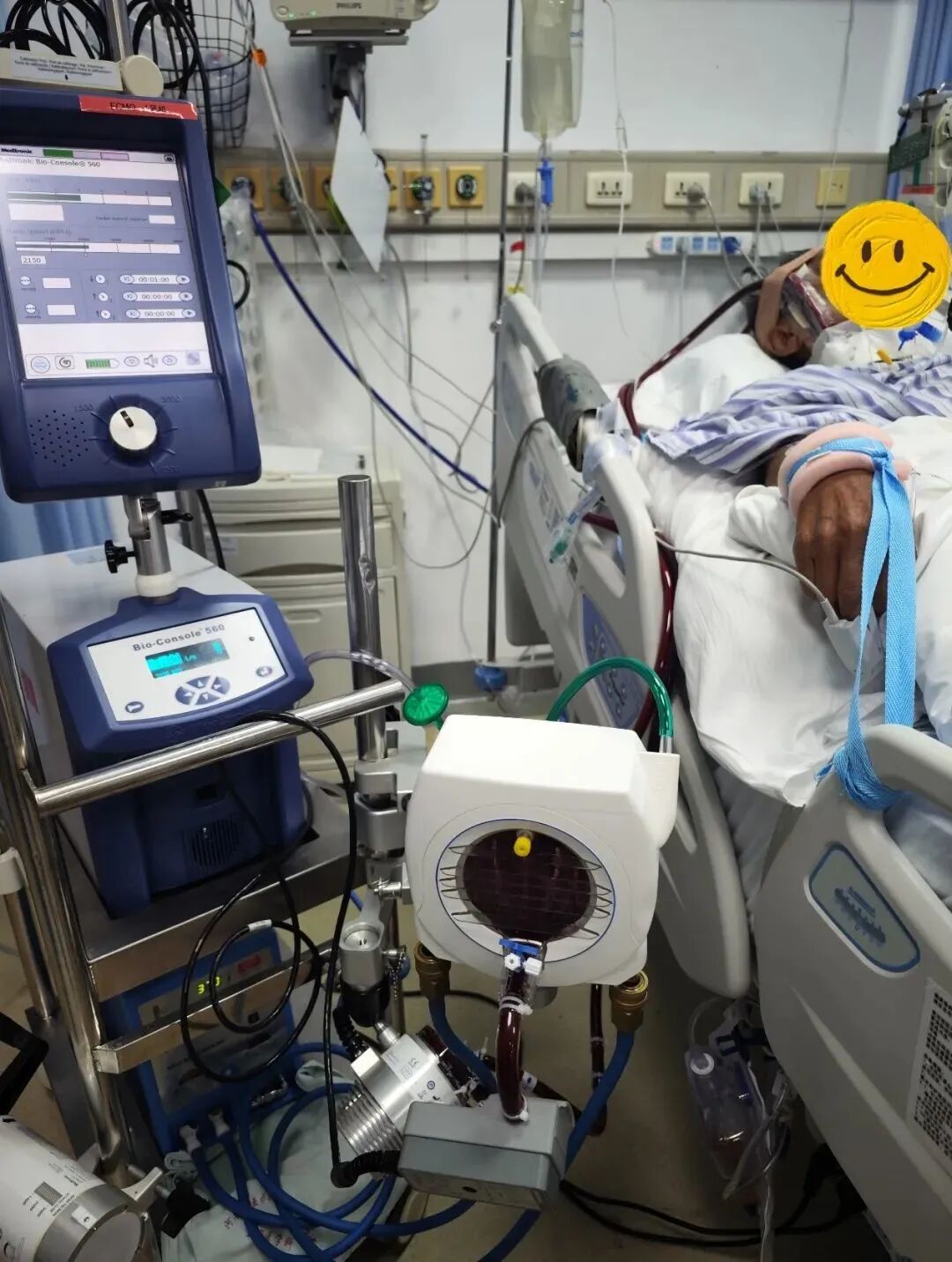 Crescent双腔·吾技无双 | 河南中医一附院开展院内首例双腔插管ECMO患者救治 -- 严道医声网