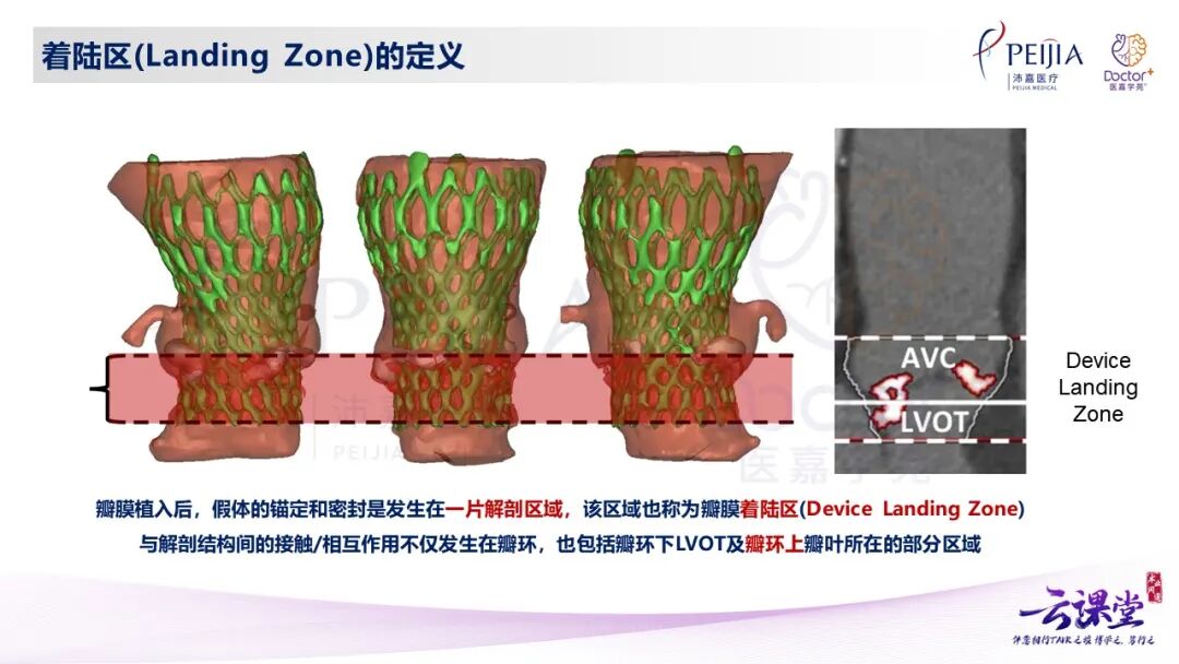 博学·笃行丨术业闻道·云课堂第四季《AS患者TAVR术前策略——层层解析全面制定》精彩回顾 -- 严道医声网