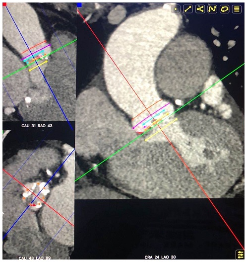 葛均波院士团队完成国内首例一站式TAVR+PTSMA术-MedSci.cn