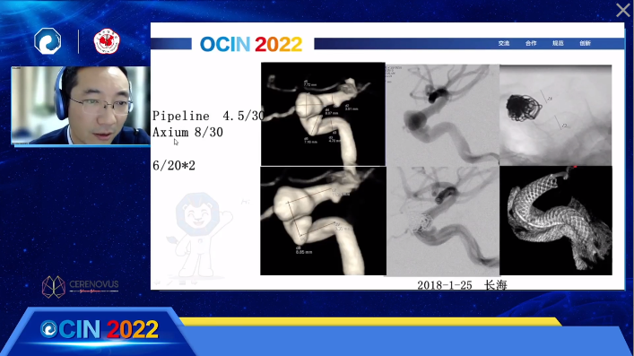 OCIN 2022 | 16日精彩回顾——五大论坛齐亮相 国际水准展神经介入新姿态 -- 严道医声网