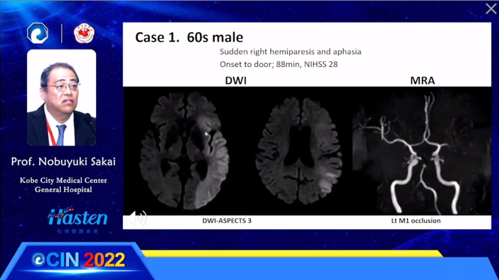 OCIN 2022 | 16日精彩回顾——五大论坛齐亮相 国际水准展神经介入新姿态 -- 严道医声网