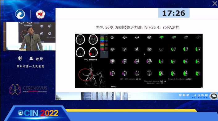OCIN 2022 | 16日精彩回顾——五大论坛齐亮相 国际水准展神经介入新姿态 -- 严道医声网