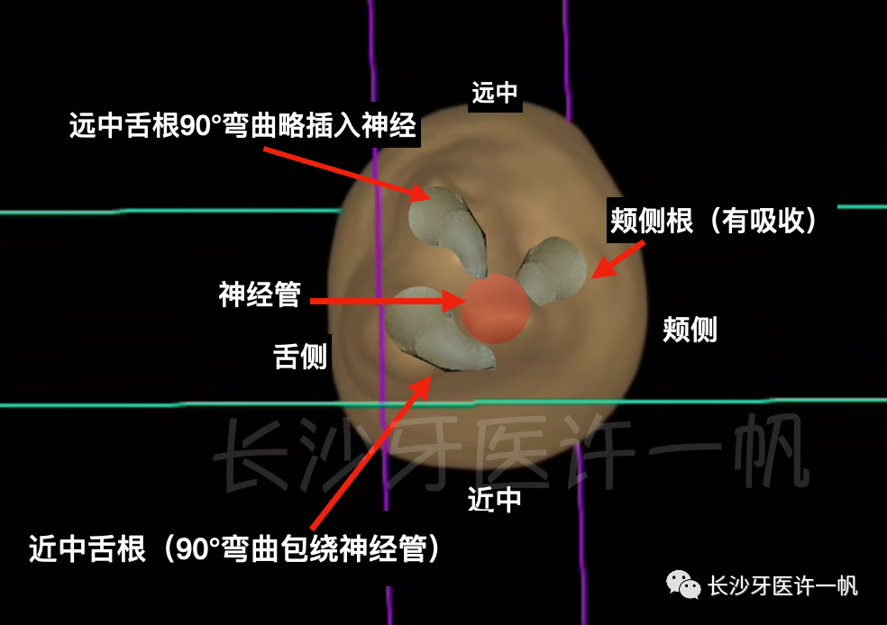 我的2023-包绕神经管90度双弯根智齿拔除病例分享-许一帆的博客-KQ88口腔博客