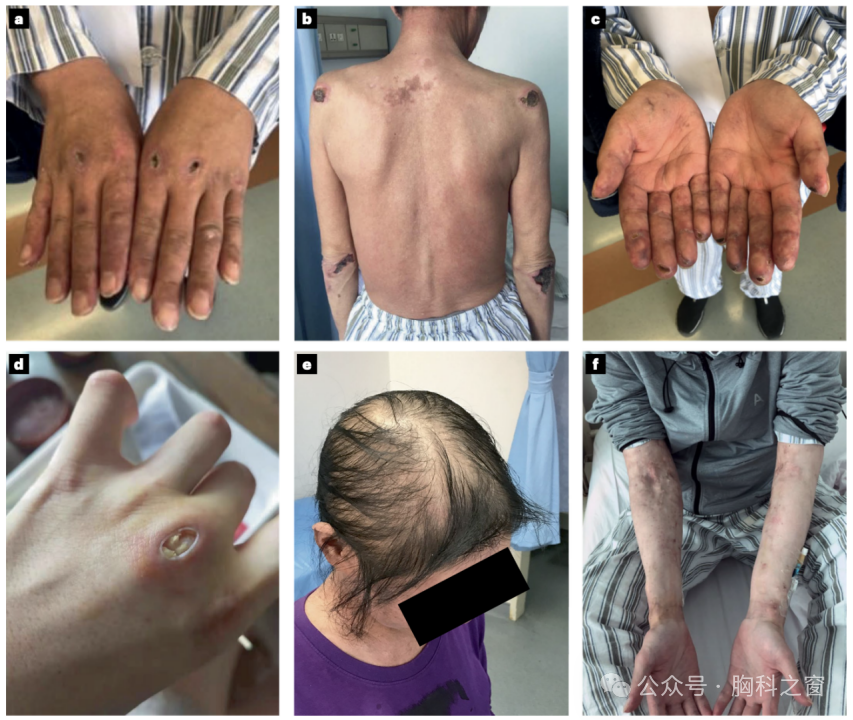 抗 MDA5 皮肌炎的发病机制及临床进展精简版 (2023.12) :: 抗 MDA5 皮肌炎研究分享