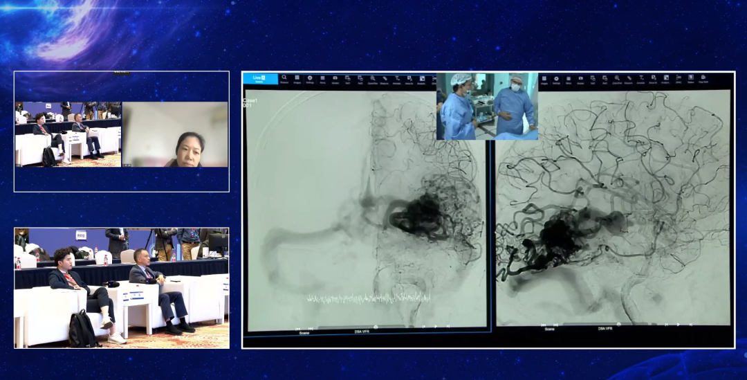 OCIN 2022丨手术直播论坛完美收官！国内国际14家中心实力联手，尽显神经介入领域最高学术水平 -- 严道脑血管网