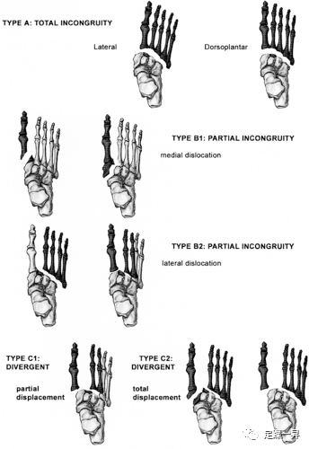 3分钟Get：Lisfranc损伤的诊疗策略！-德医医学-助力医学教育发展！