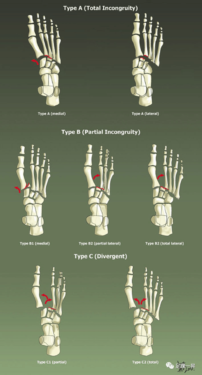 3分钟Get：Lisfranc损伤的诊疗策略！-德医医学-助力医学教育发展！