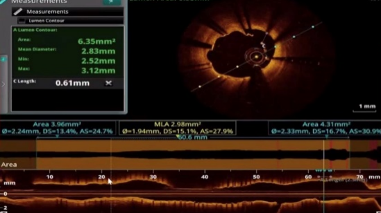 聚焦光学相干断层成像技术（OCT）- 北京腔内影像俱乐部（BIC）系列精品课程开讲啦！ -- 严道医声网