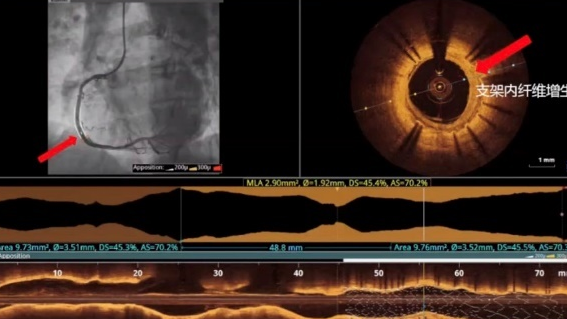 聚焦光学相干断层成像技术（OCT）- 北京腔内影像俱乐部（BIC）系列精品课程开讲啦！ -- 严道医声网