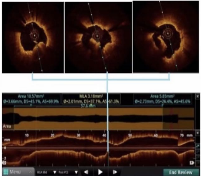 聚焦光学相干断层成像技术（OCT）- 北京腔内影像俱乐部（BIC）系列精品课程开讲啦！ -- 严道医声网