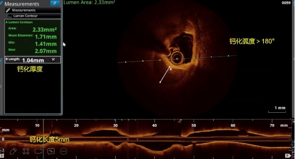 聚焦光学相干断层成像技术（OCT）- 北京腔内影像俱乐部（BIC）系列精品课程开讲啦！ -- 严道医声网