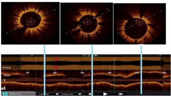 聚焦光学相干断层成像技术（OCT）- 北京腔内影像俱乐部（BIC）系列精品课程开讲啦！ -- 严道医声网