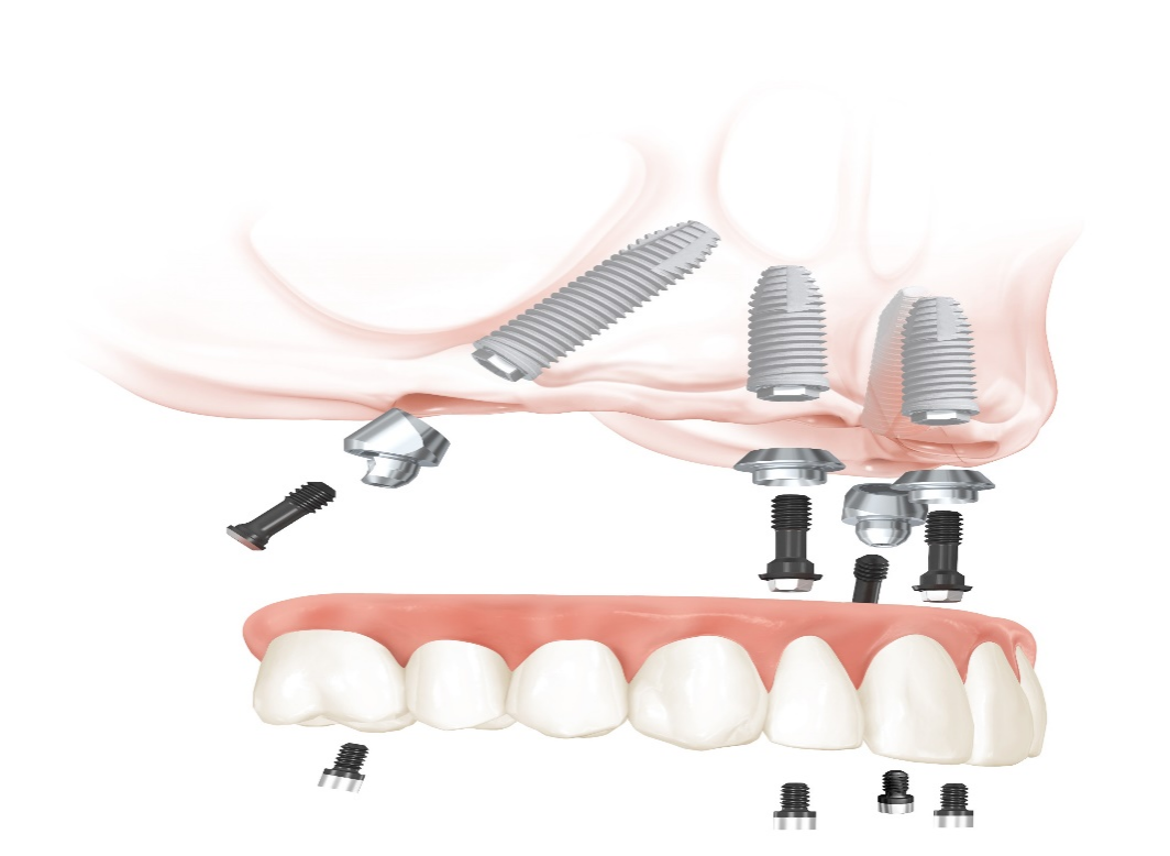 全口种植义齿你真的了解吗？ - 牙齿种植 - 口腔科普 - 西安存济医学中心