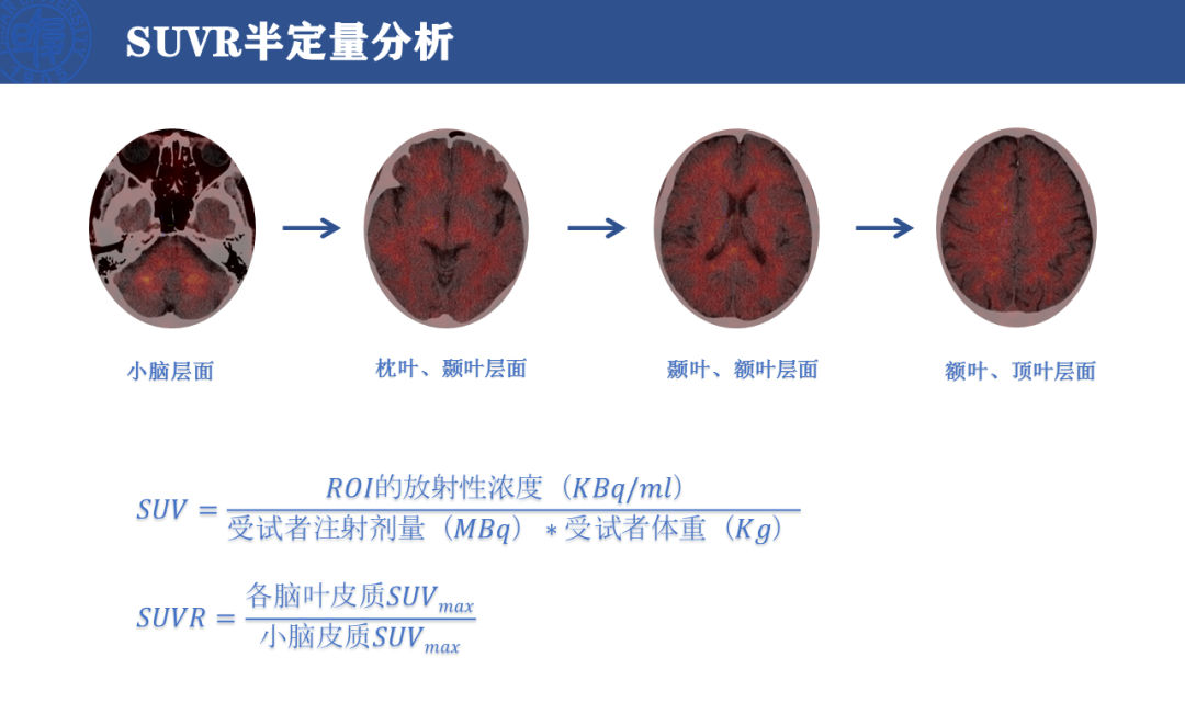 科学网—轻度认知功能障碍与阿尔茨海默病18F-flutemetamol PET/CT脑显像初步研究 - 霍宏的博文