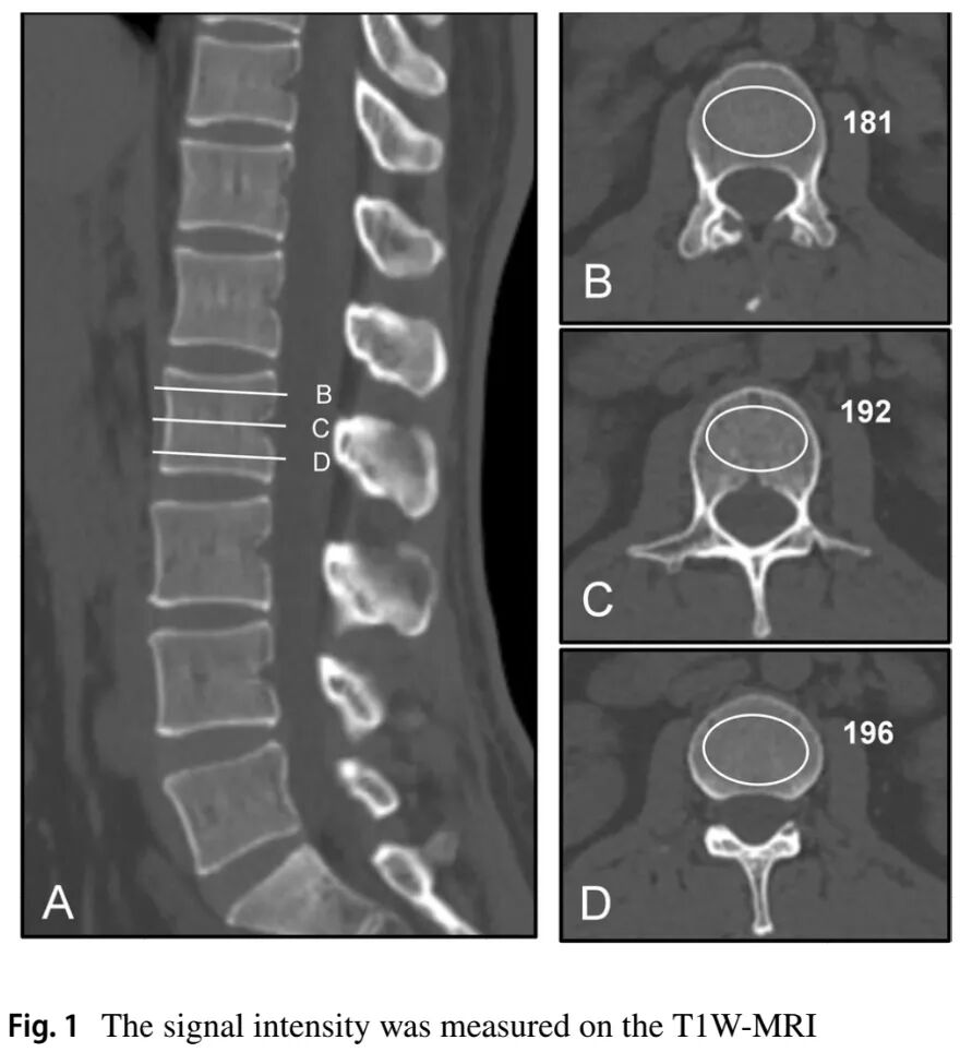 4.0/Q1，腰椎CT/MRI不要只看病灶！昆明医附属延安医院AI＋深度学习让骨质疏松筛查发高水平论文 - Py学习