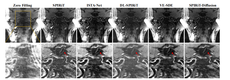 SPIRiT-Diffusion：基于自一致性驱动的加速MRI扩散模型|文献速递-基于深度学习的病灶分割与数据超分辨率 - 影像组学科研世界 ...