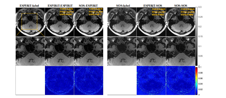 SPIRiT-Diffusion：基于自一致性驱动的加速MRI扩散模型|文献速递-基于深度学习的病灶分割与数据超分辨率 - 影像组学科研世界 ...