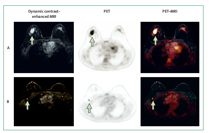 文献速递：PET-影像组学专题--临床上在乳腺癌方面PET-MRI的进展 - 影像组学科研世界 | 国内第一个影像组学论坛